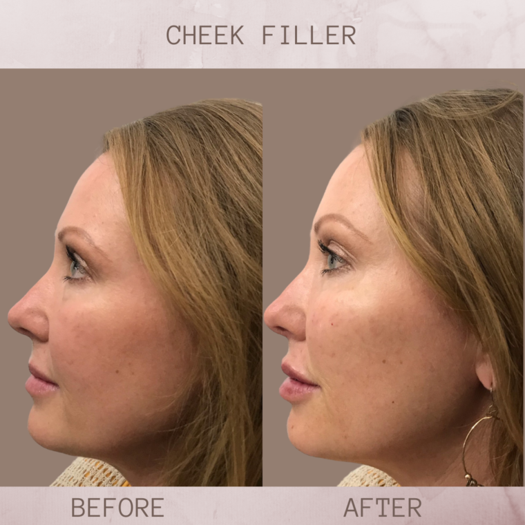 Cheek Filler - Eluma - Laser & Aesthetics