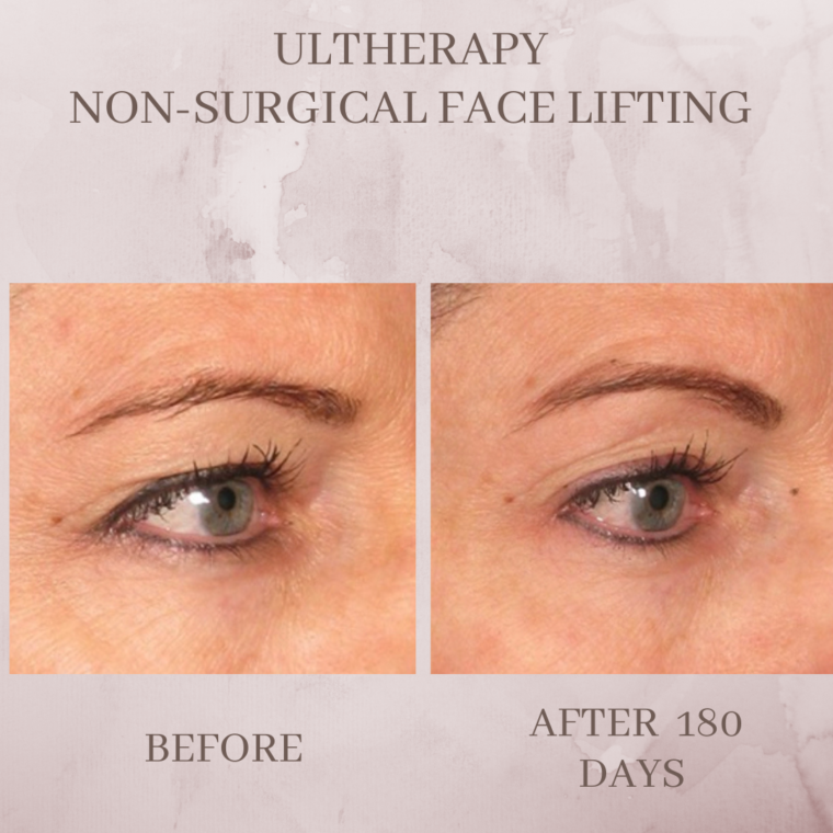 Ultherapy - Eluma - Laser & Aesthetics