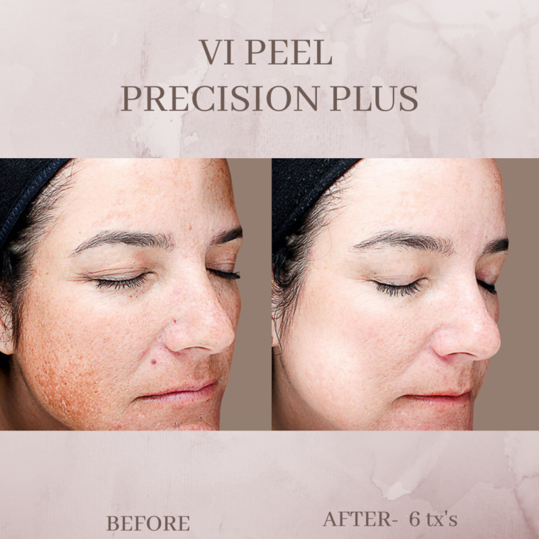 VI PEEL - Eluma - Laser & Aesthetics